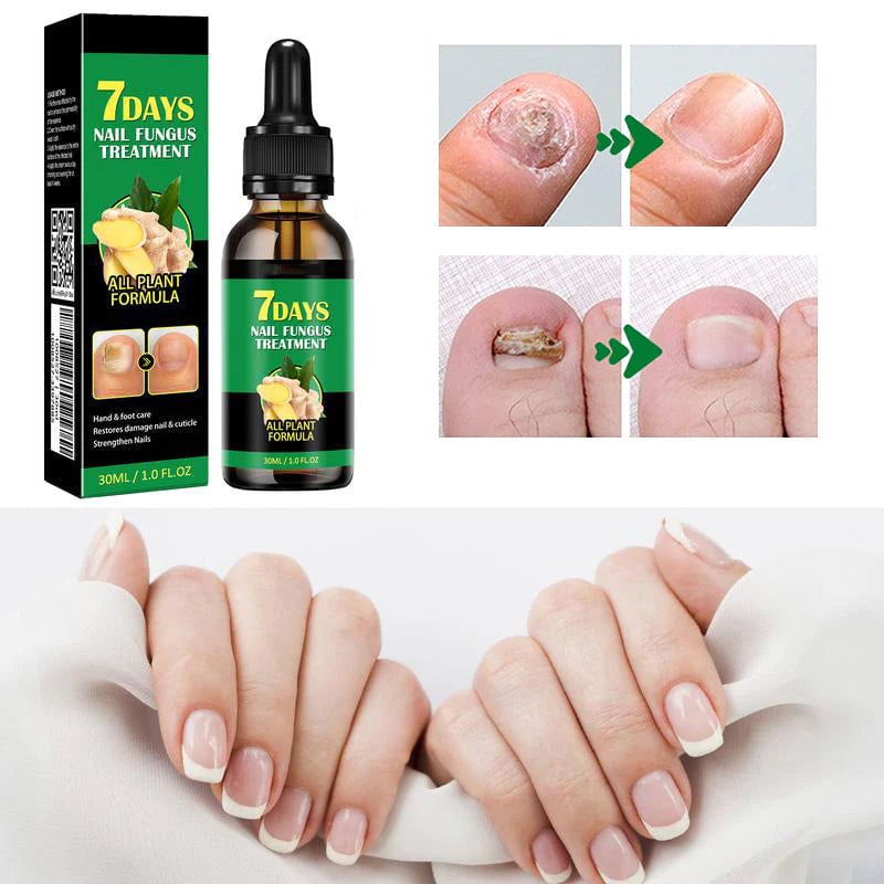 Ginger Nail Treatment – rowgins